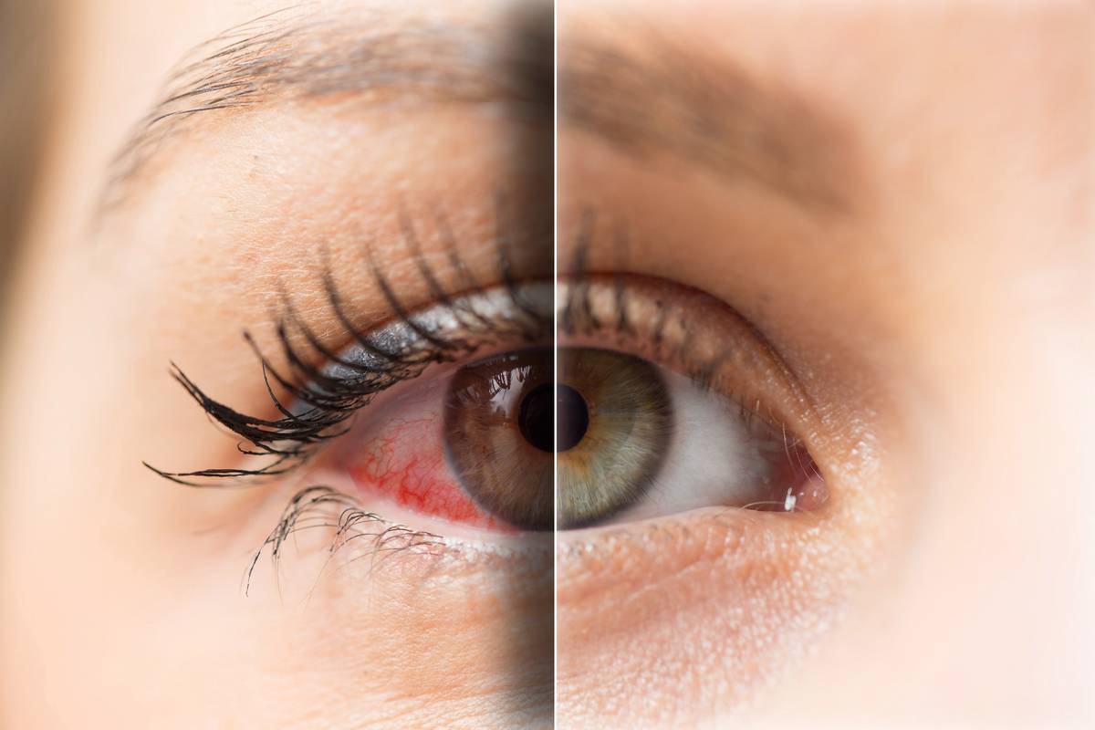 Eyes Like The Sahara How To Stop Dry Eyes When You Wear Contacts
